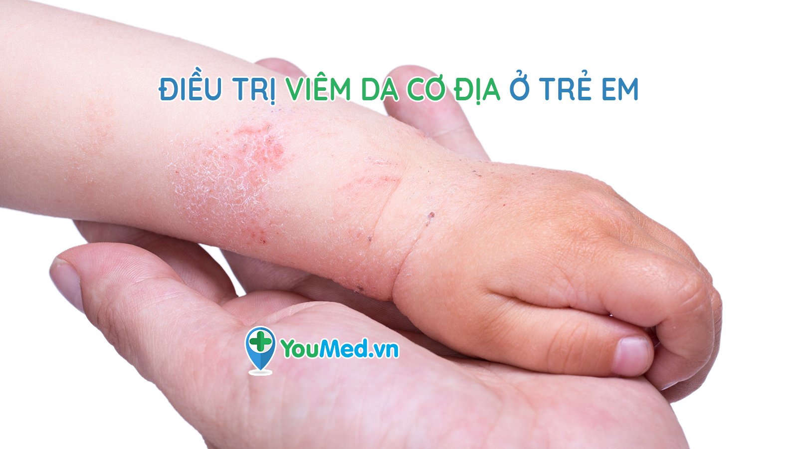Viêm da cơ địa ở trẻ em: Phụ huynh nhất định phải biết - YouMed
