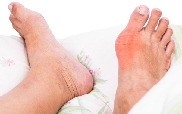 Gout: Đã không còn là căn bệnh của người giàu! - YouMed