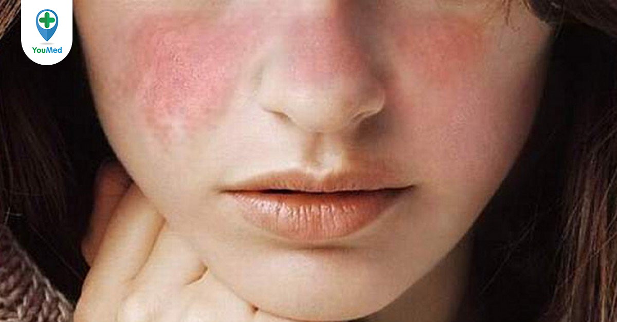 Lupus ban đỏ: Nguyên nhân, triệu chứng và cách điều trị - YouMed