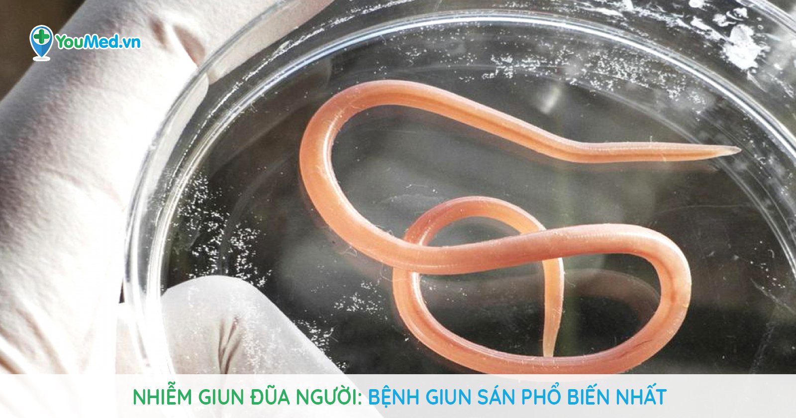 Nhiễm giun đũa người: Bệnh giun sán phổ biến nhất - YouMed