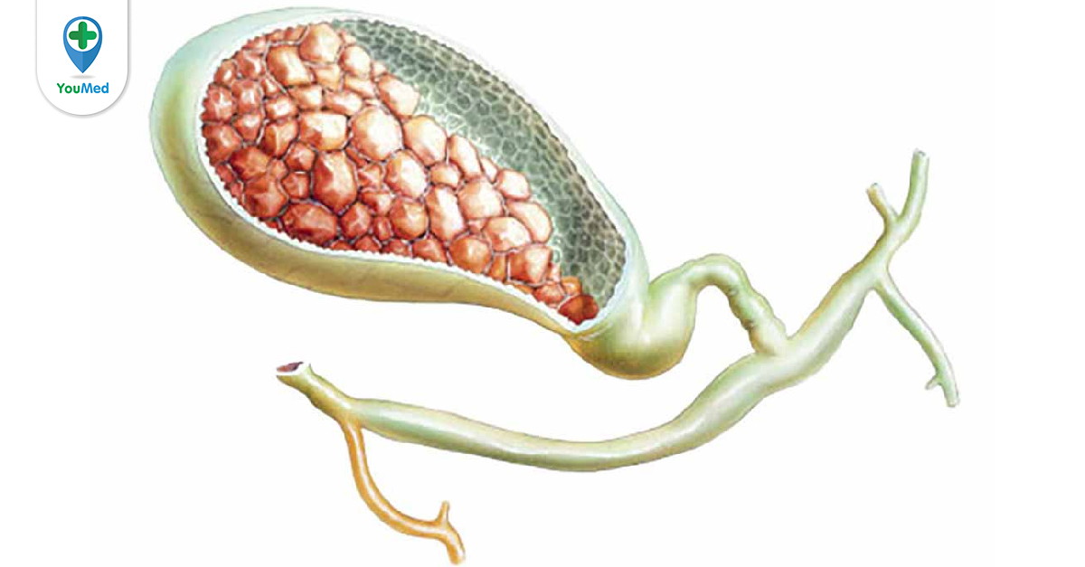 Sỏi túi mật: Nguyên nhân, chẩn đoán và điều trị - YouMed