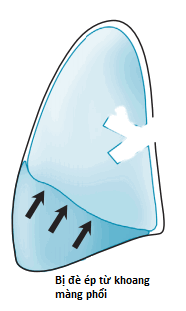 Xẹp phổi: nguyên nhân, triệu chứng và cách điều trị - YouMed