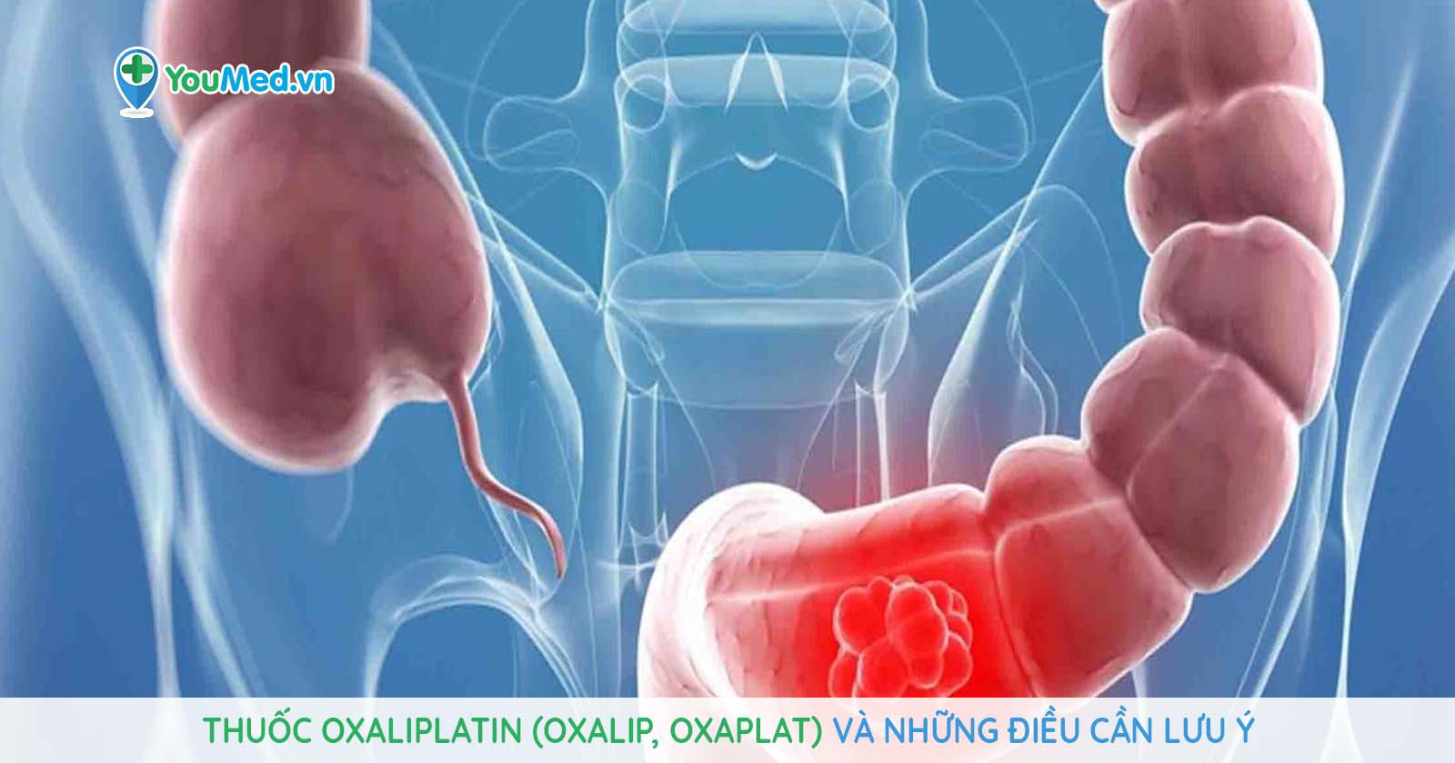Thuốc Oxaliplatin (Oxalip, Oxaplat) và những điều cần lưu ý - YouMed