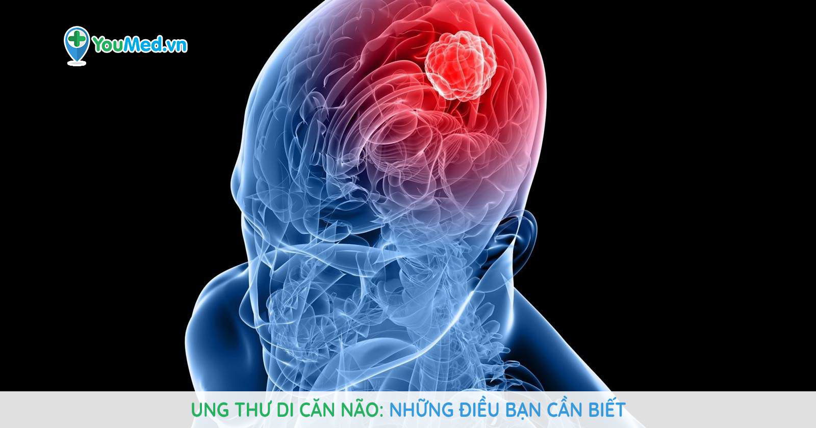 Ung thư di căn não: Những điều bạn cần biết - YouMed