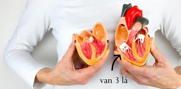Bệnh van ba lá: Nguyên nhân, triệu chứng, cách điều trị