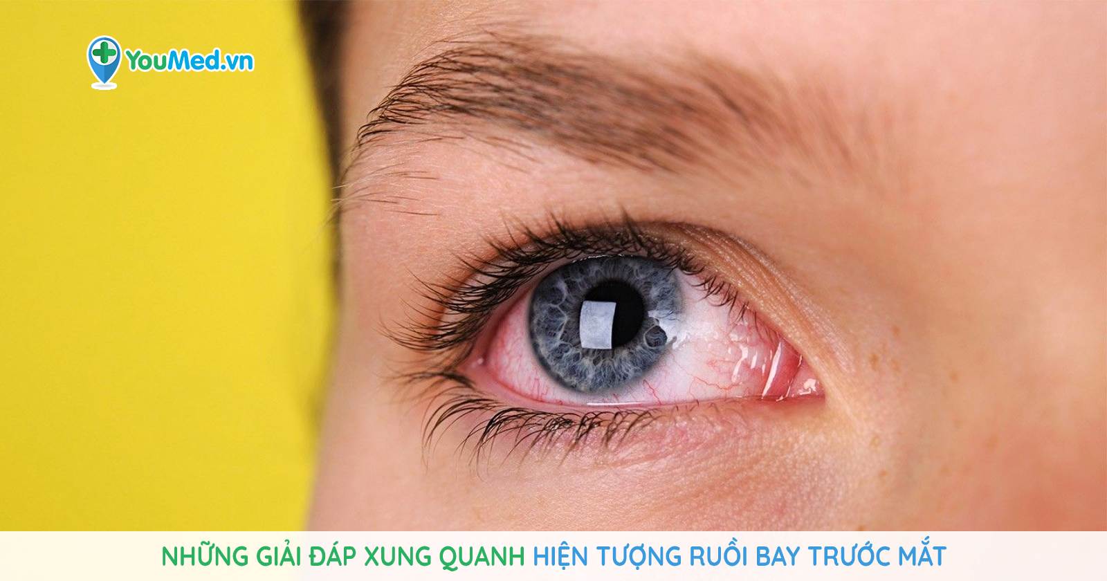 Những giải đáp xung quanh hiện tượng ruồi bay trước mắt - YouMed