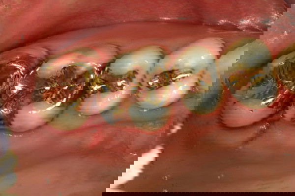 Trám răng và những điều cần biết - YouMed