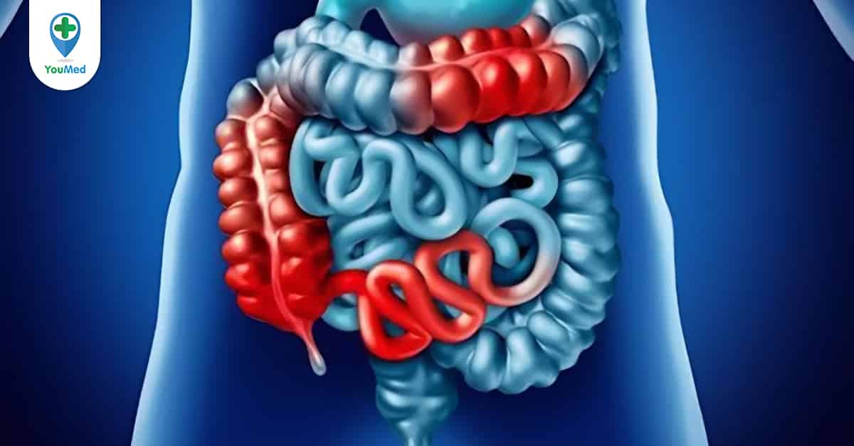 Gen APC là gì? Có tác động như thế nào đến cơ thể? - YouMed