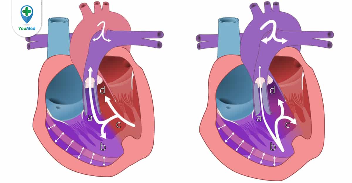 Không lỗ van ba lá: Nguyên nhân, chẩn đoán và điều trị - YouMed