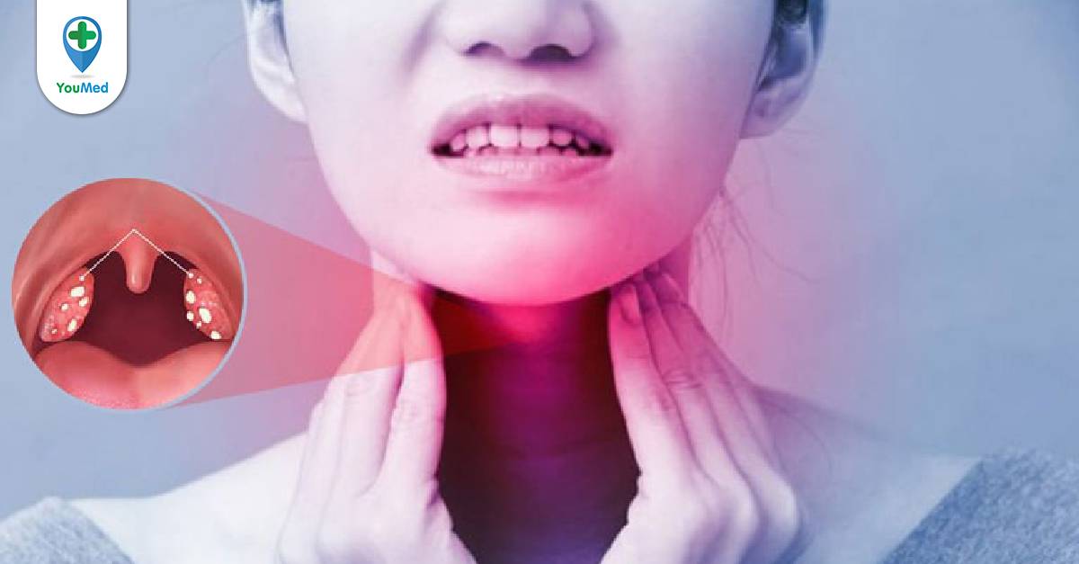Thuốc kháng sinh điều trị viêm amidan: Cách dùng và các lưu ý - YouMed