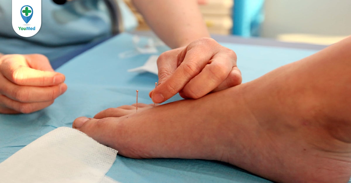 Châm cứu bàn chân và những điều bạn cần lưu ý - YouMed
