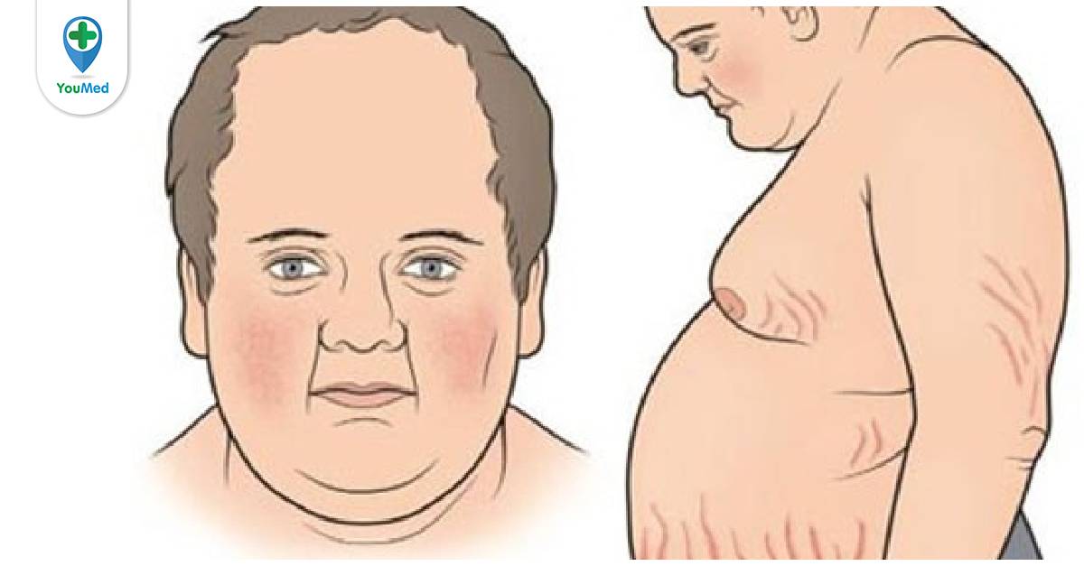 Thuốc điều trị hội chứng Cushing và những thông tin liên quan - YouMed