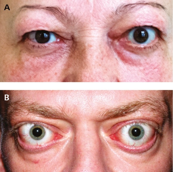 Bướu cổ basedow và những lưu ý đến từ bác sĩ - YouMed