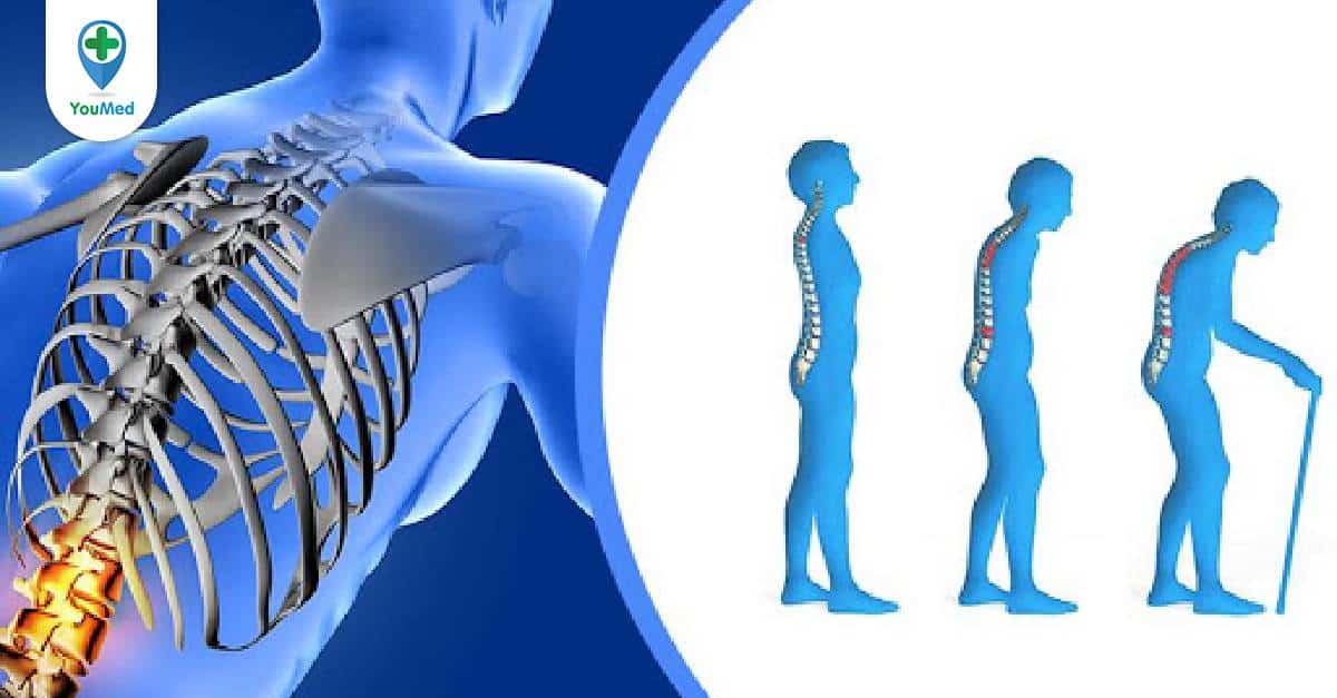 Loãng xương ở người già và phân loại các cấp độ bệnh - YouMed