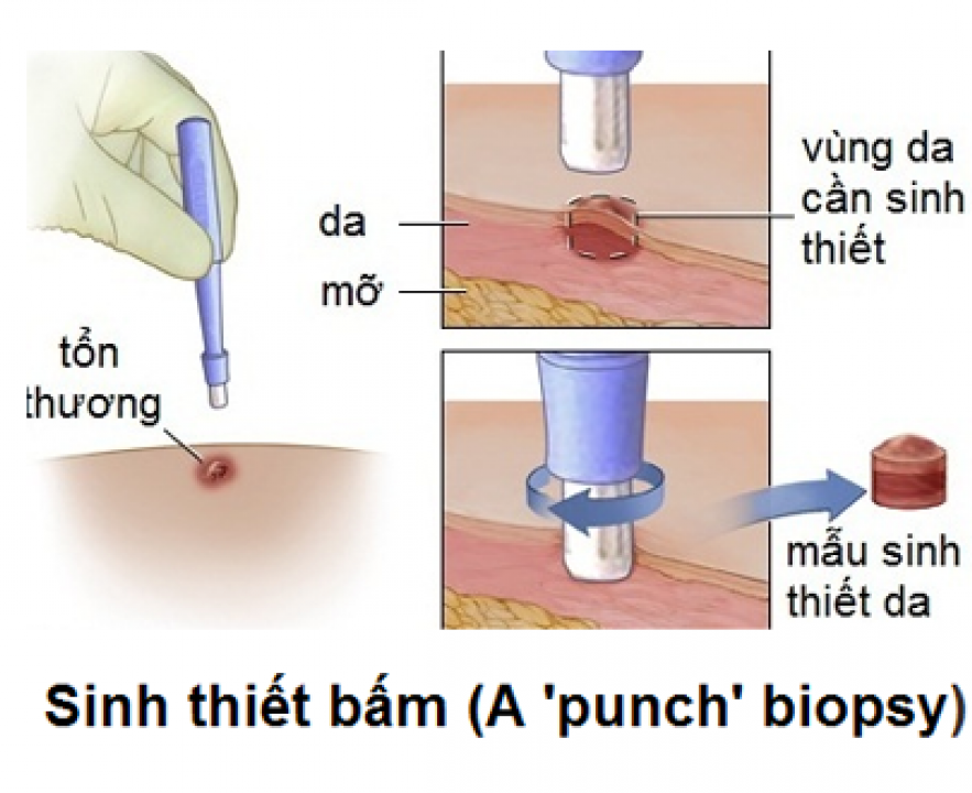 Hội chứng Stevens - Johnson: nguyên nhân, dấu hiệu và điều trị - YouMed