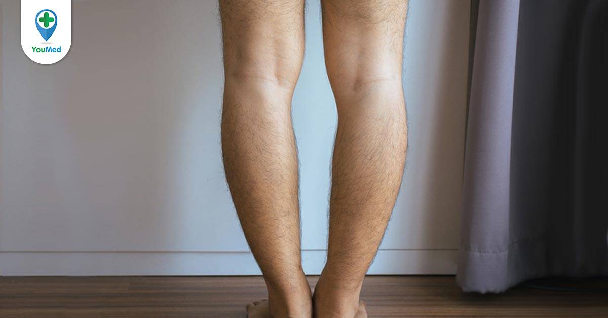 Chân vòng kiềng: Nguyên nhân và các bài tập khắc phục - YouMed