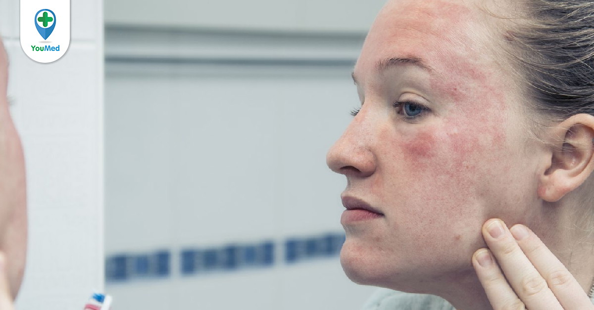 Hội chứng Stevens - Johnson: nguyên nhân, dấu hiệu và điều trị - YouMed