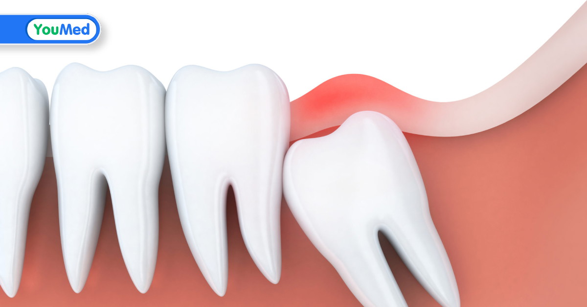 Cách trị sưng nướu răng khôn hiệu quả - YouMed